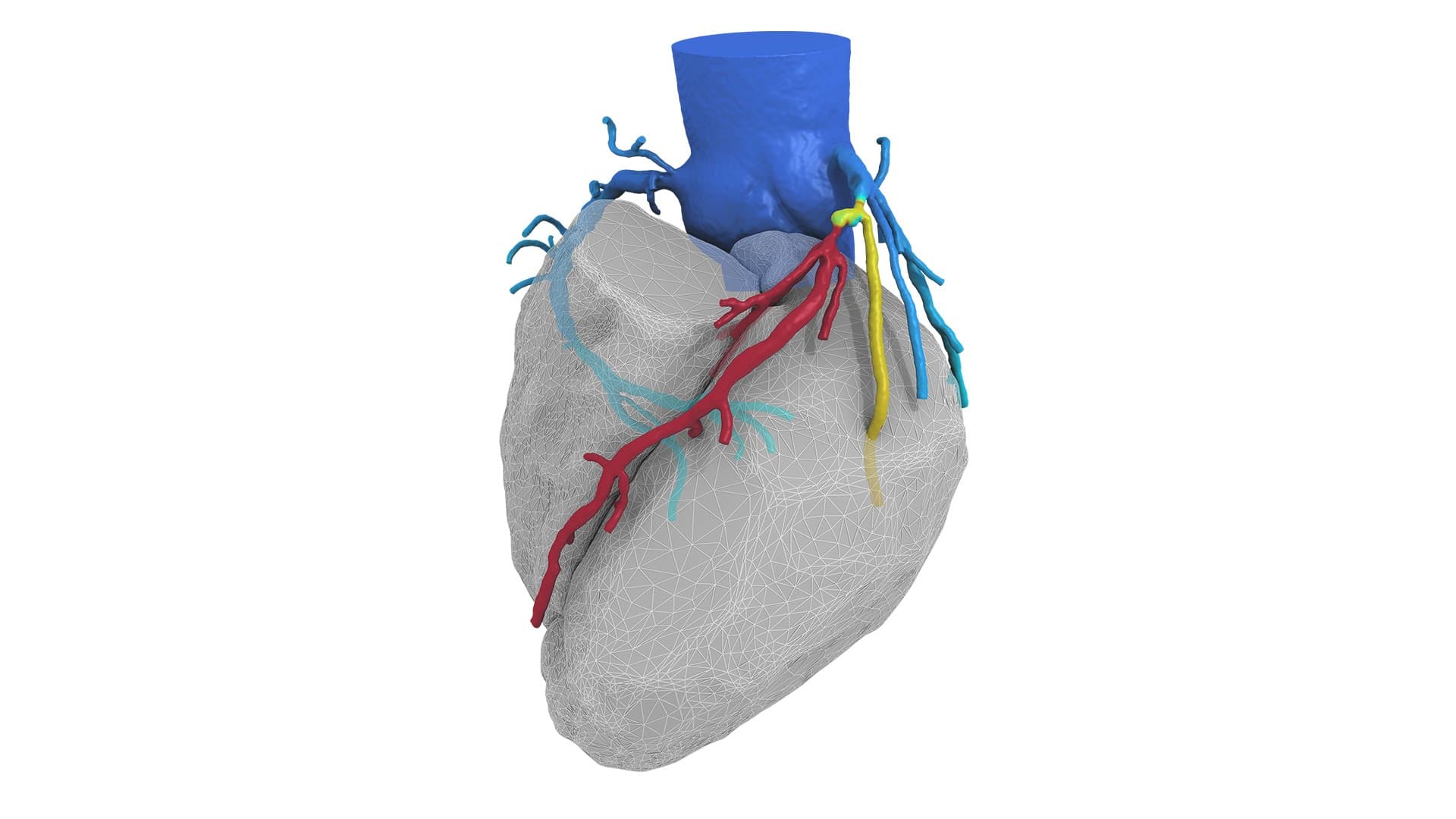 聰明地診斷心臟病：HeartFlow 如何運用人工智慧來偵測心臟病 - NVIDIA 台灣官方部落格